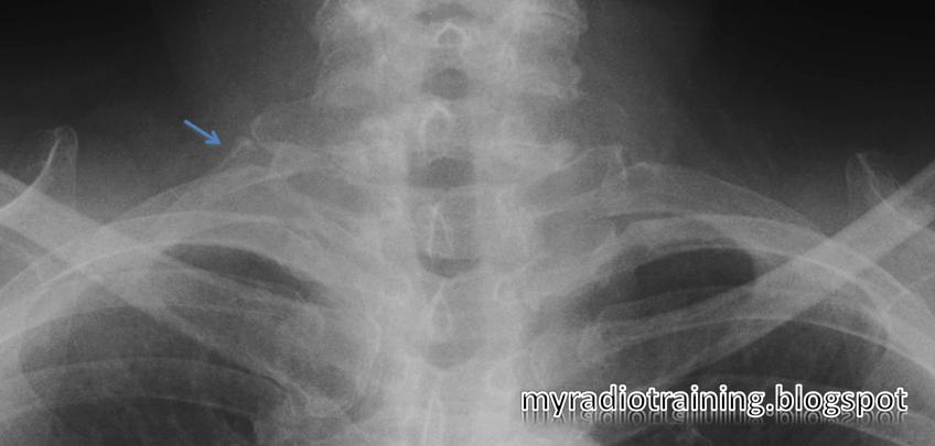 Radiology info hub: Normal Variant: Cervical Rib