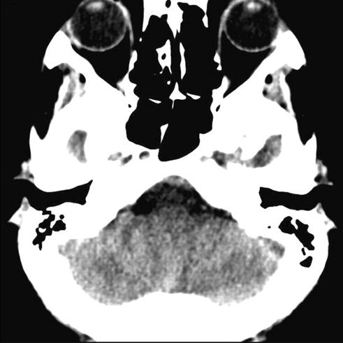 ABC Radiology Blog: Computed Tomography Artifacts
