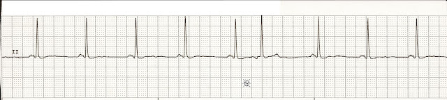 EKG Rhythm Strip Quiz 57: Ectopic Beats