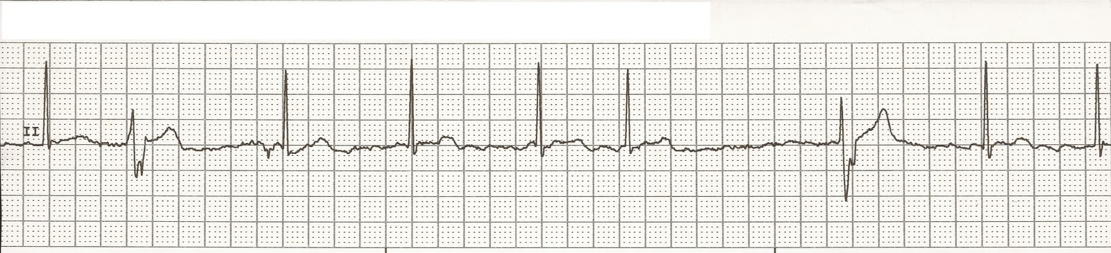 Float Nurse: EKG Rhythm Strips 26: Ectopic beats