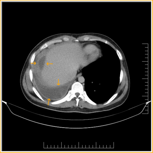 Appendicitis complicated with Subphrenic Abscess - Sumer's Radiology Blog