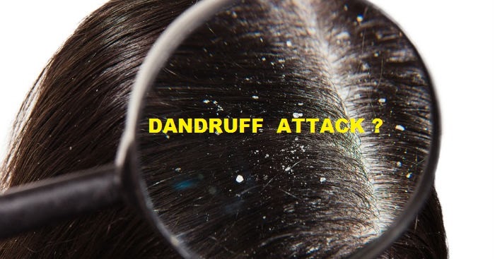 How to Overcome or Eliminate Dandruff ~ akufisio.blogspot