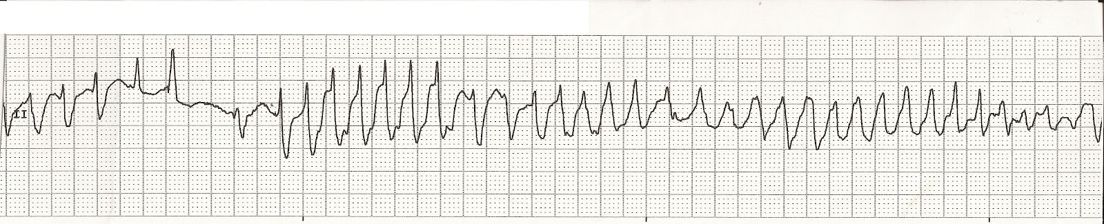 EKG Rhythm Strip Quiz 47