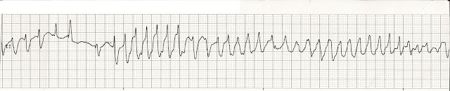 EKG Rhythm Strip Quiz 47