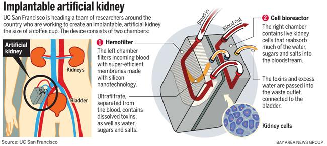 Can we create an artificial/mechanical kidney to treat kidney failure?
