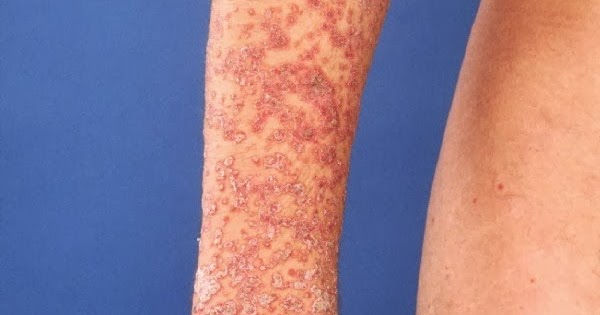 ⇢ Psoriasis Guttata Causas | ¿Cuales son Las Causas De La Psoriasis ...