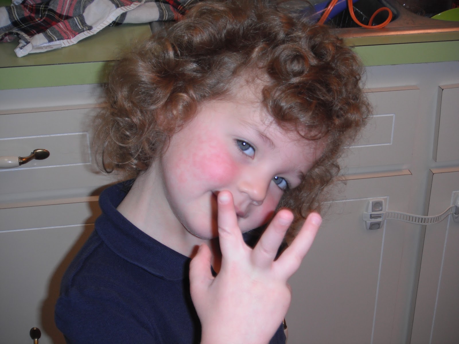 World Wide Wards: "Slapped cheek" rash