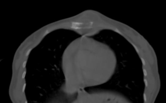 Sternal Tuberculosis-CT - Sumer's Radiology Blog