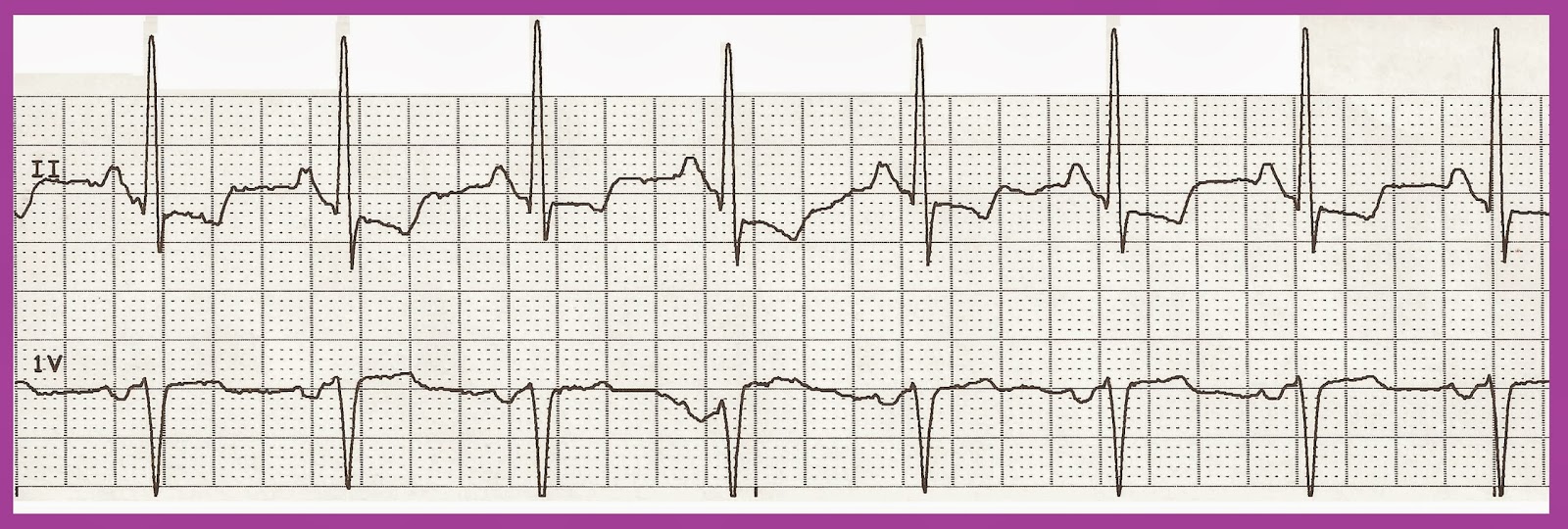 Practice EKG Rhythm Strips 216