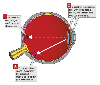 Macular Degeneration Society (Singapore): IOL-Vip restores vision in ...
