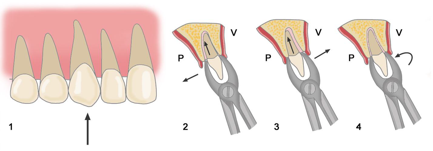 Técnicas de exodoncia.