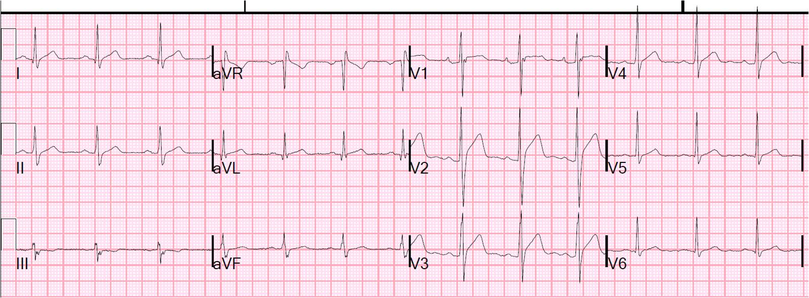 Dr. Smith's ECG Blog: Several Cases of ST Elevation from Early ...