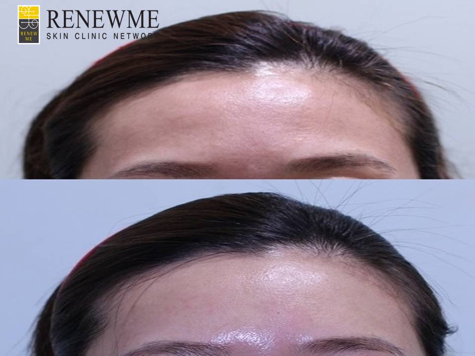 Renewme Skin Clinic: Make beatiful foreheads and Make small face too!