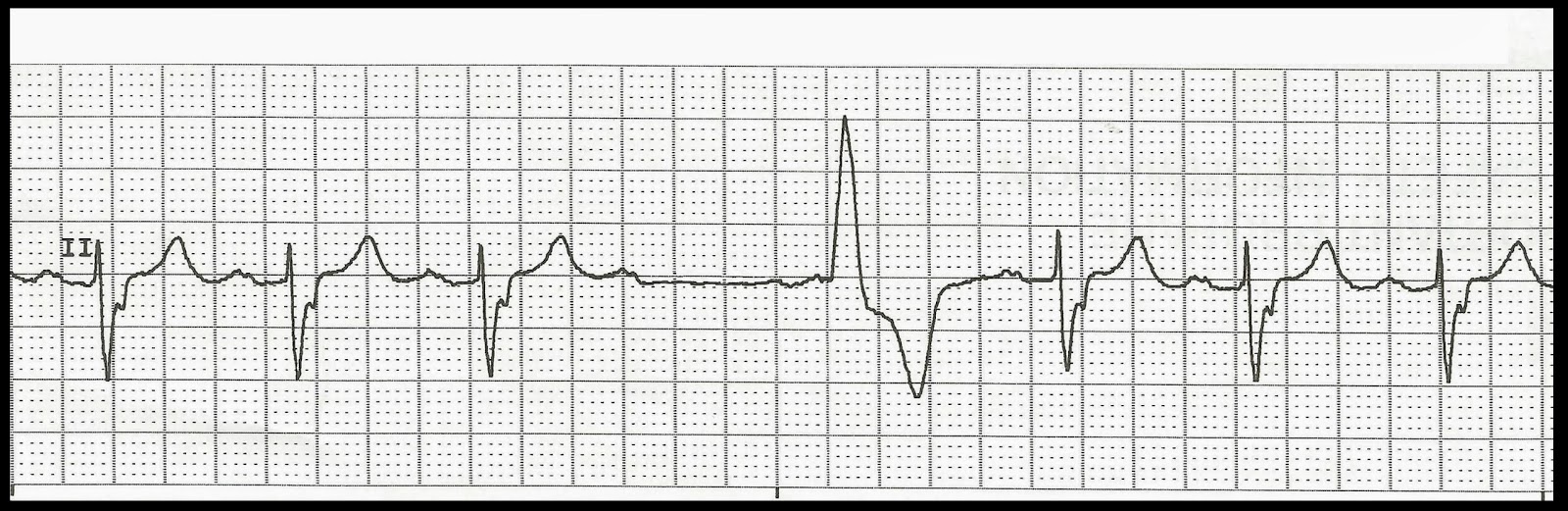 Ventricular Escape Rhythm