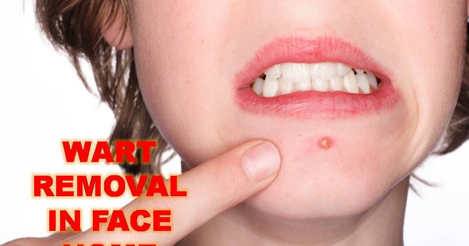 WARTS- 3 Best Way To Remove Warts From Face Naturally At Home