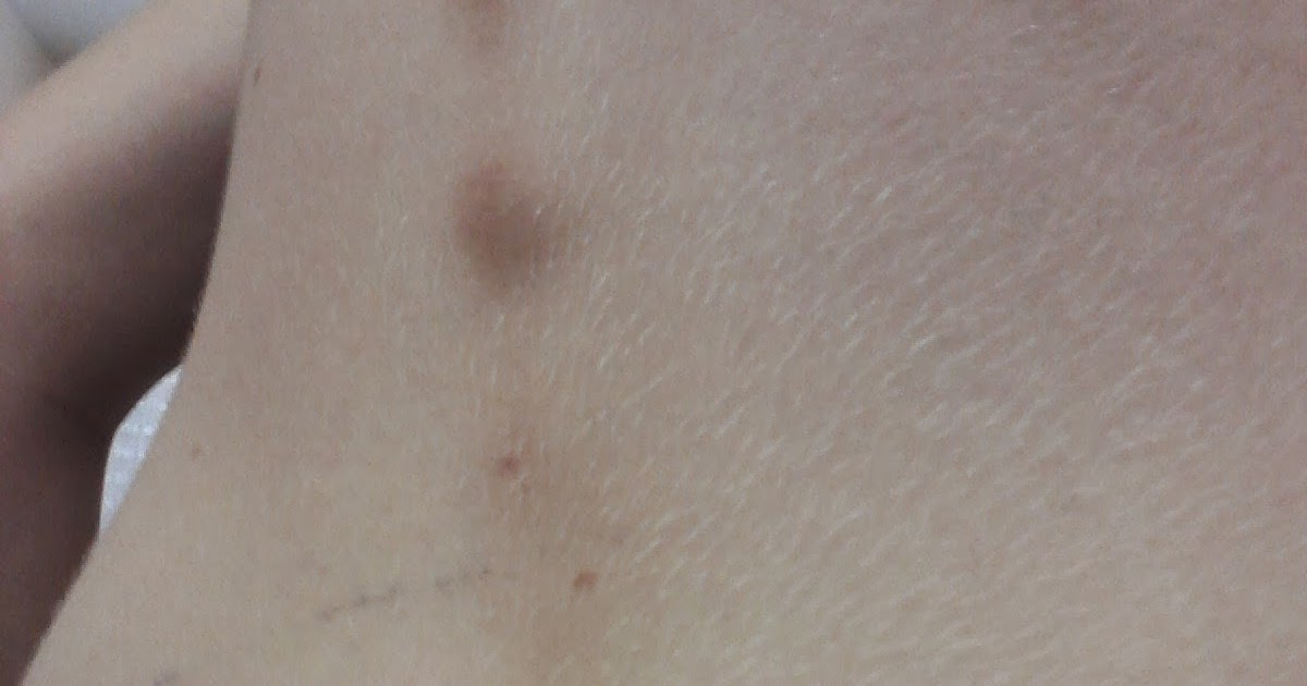 The Struggles of ITP: Bone Marrow Biopsy and Spinal Bruising