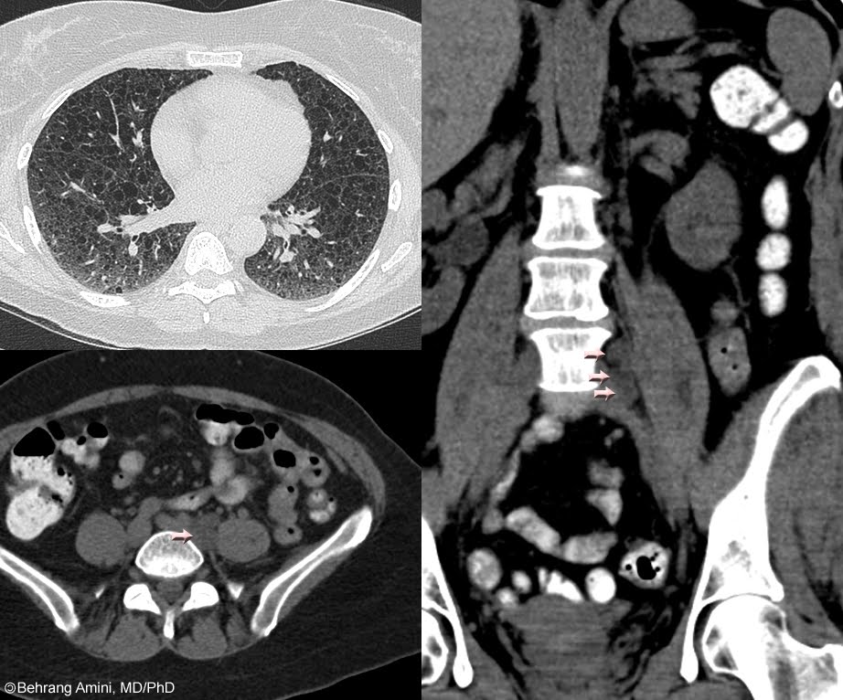 Roentgen Ray Reader: Lymphangioleiomyoma