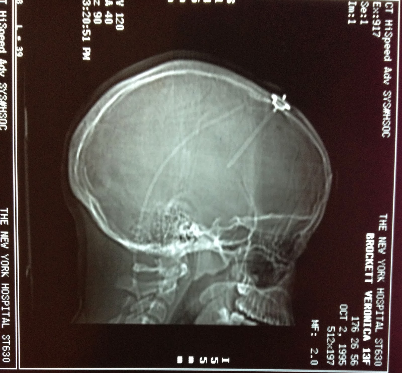 Shunt Chronicles: Nerve 6