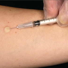 Ilman Silanas Blog: ANTBIOTIC SKIN TEST (AST) : DETEKSI DINI ALERGI ...