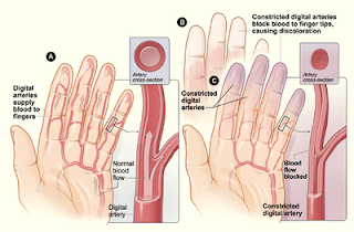 Cancer Symptoms: What is Gangrene symptoms