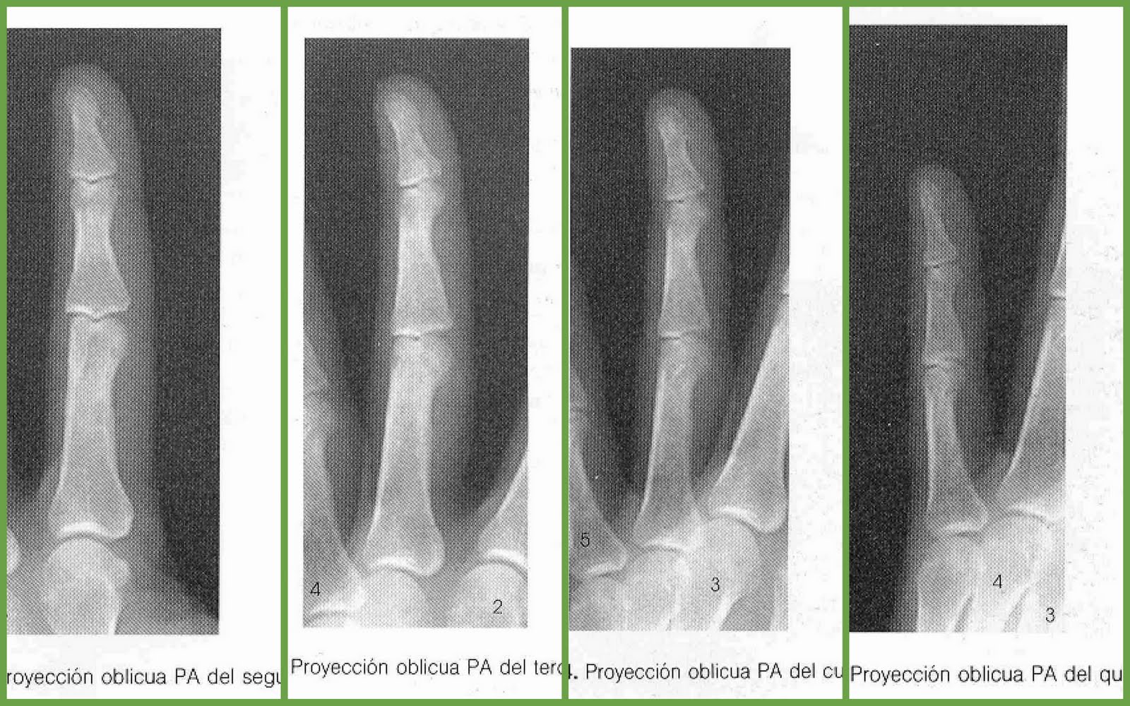 tecradiologos: DEDOS: SEGUNDO A QUINTO.