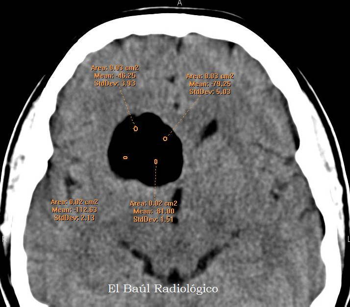 El Baúl Radiológico: 2) QUISTE DERMOIDE INTRACRANEAL (Intracranial ...