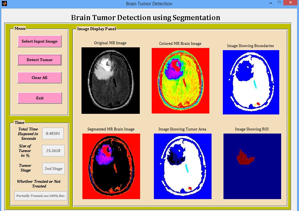 An Efficient Brain Tumor Detection Algorithm Using Watershed And Segmentation Methods ~ Matlab