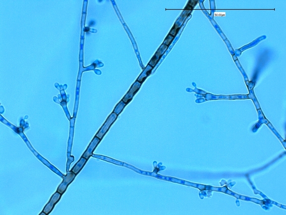 Fun With Microbiology (What's Buggin' You?): Fonsecaea pedrosoi/monophora