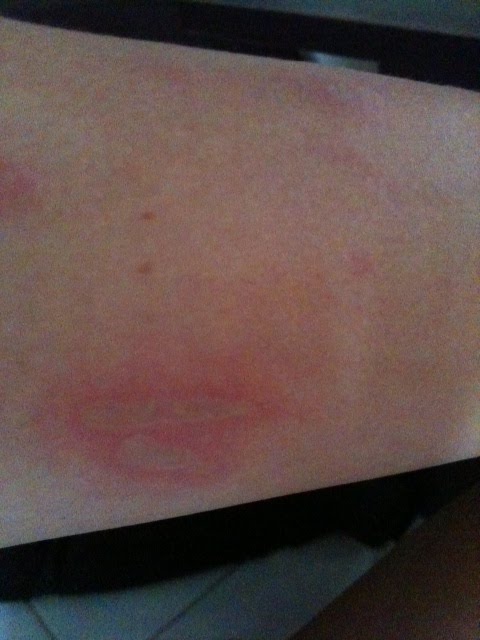 .Melissa's: Charlie / Penyakit Kulit Kumbang Rove