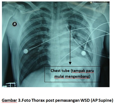 BEDAH UMUM FKUI: Open Pneumothorax