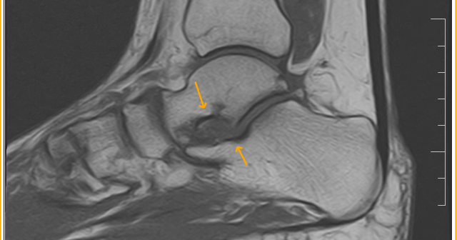 Sinus Tarsi Syndrome : MRI - Sumer's Radiology Blog