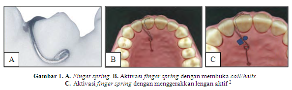 My little notes about dentistry: Beberapa Desain Kawat pada Pesawat ...