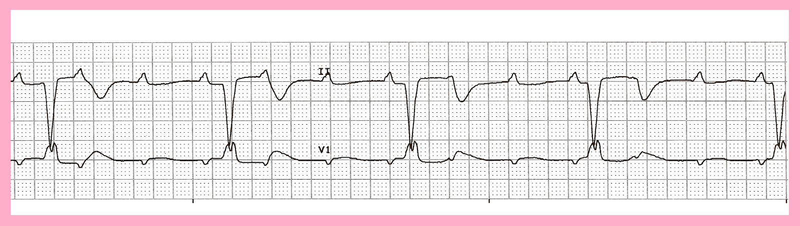 EKG Rhythm Quiz 268