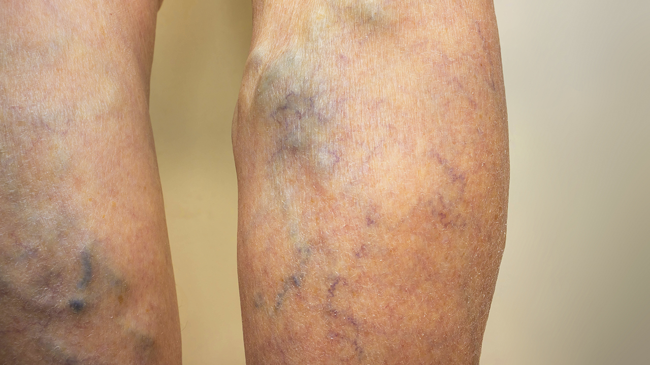 Clínicaibm.com: La fondaparinux y la tromboflebitis