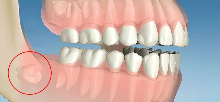 Entendiendo mi sonrisa : Dientes Retenidos
