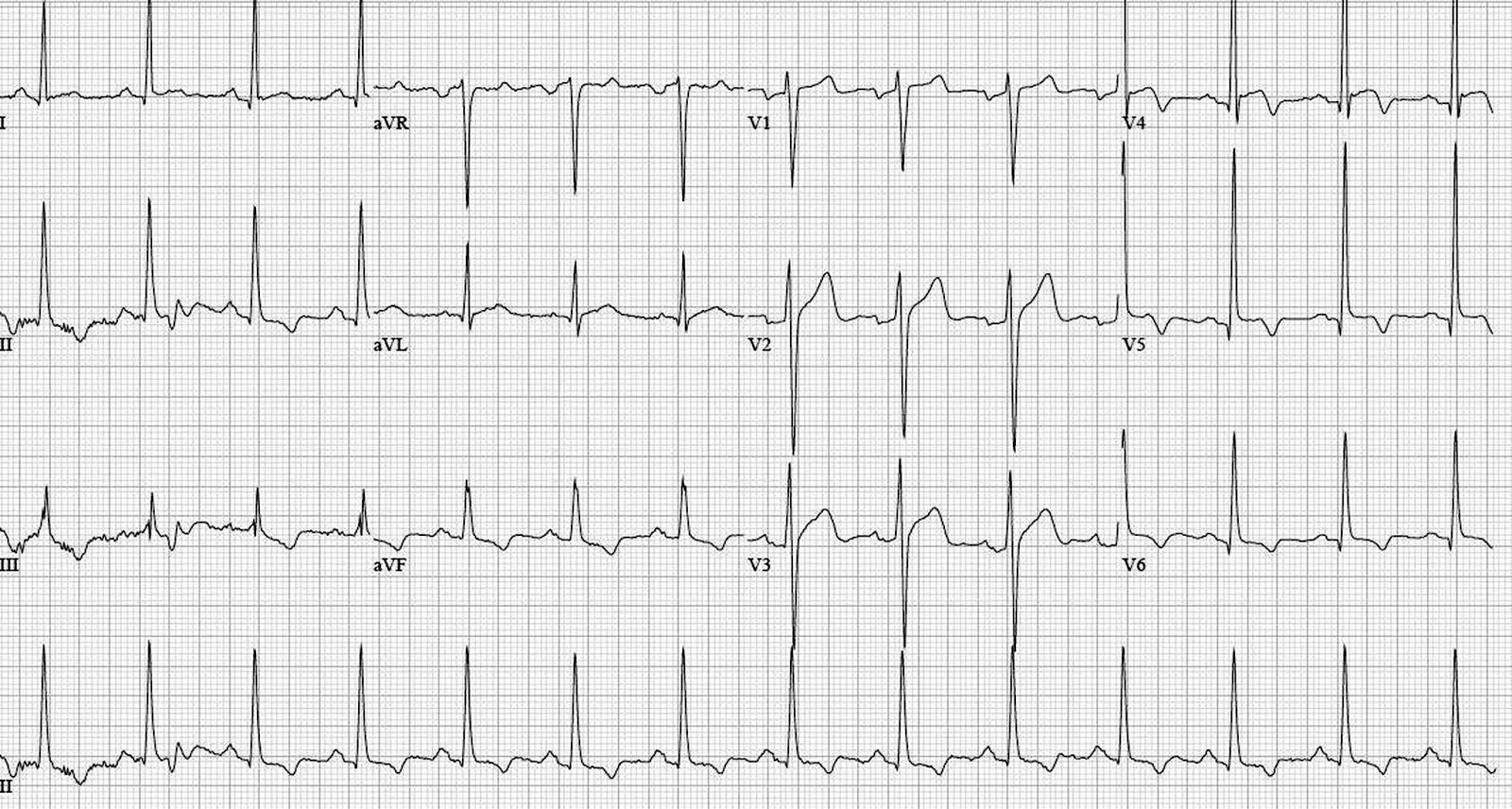 ECG Rhythms: Global T wave inversions in a Patient with CVA