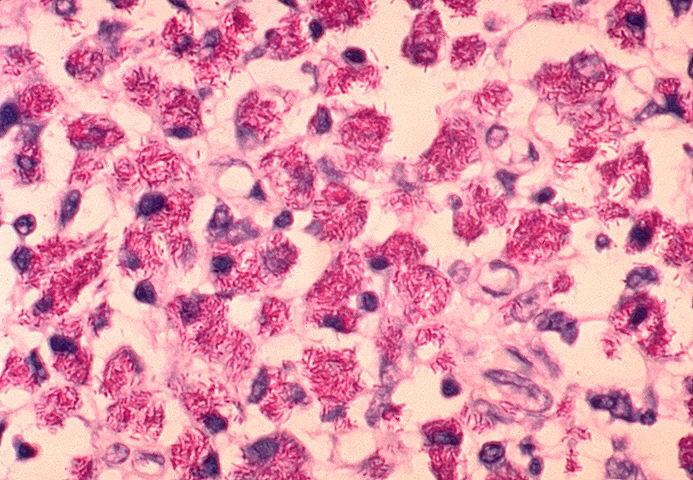 Castonguay : Infection Control: Uncommon Skin Infection Linked to ...