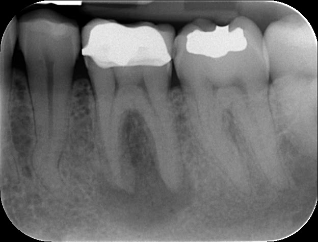 Caso Clínico Master: La endodoncia cura