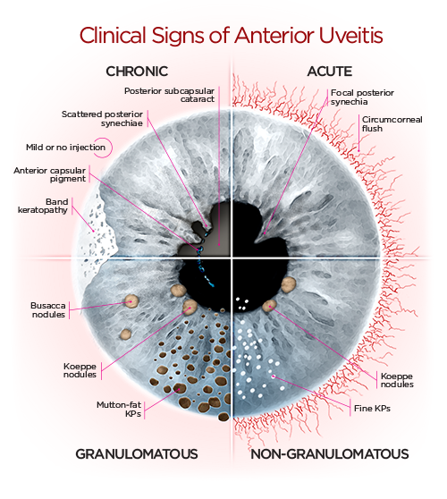 Facts about Phacoemulsification on Uveitic patients - Eye Health Nepal