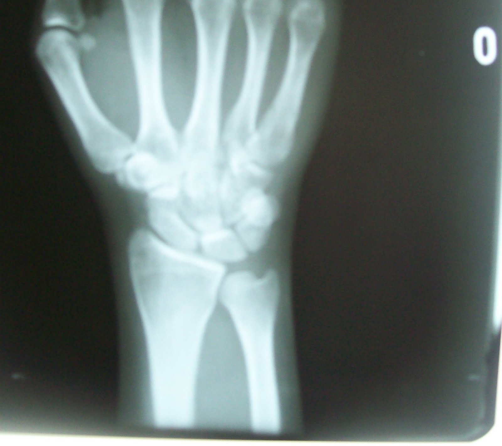 Rx011: Proyecciones Muñeca