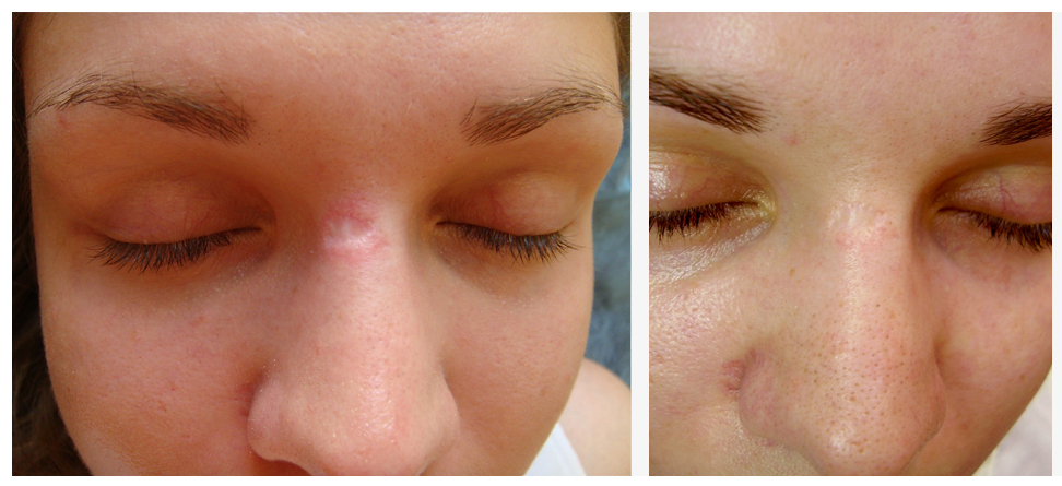 Mediskin: Skin Needling