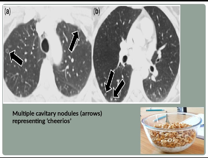 Chest Medicine Made Easy-Dr Deepu: Cherio sign