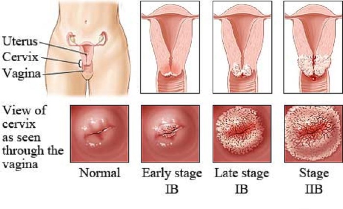 pictures of stage stds in women
