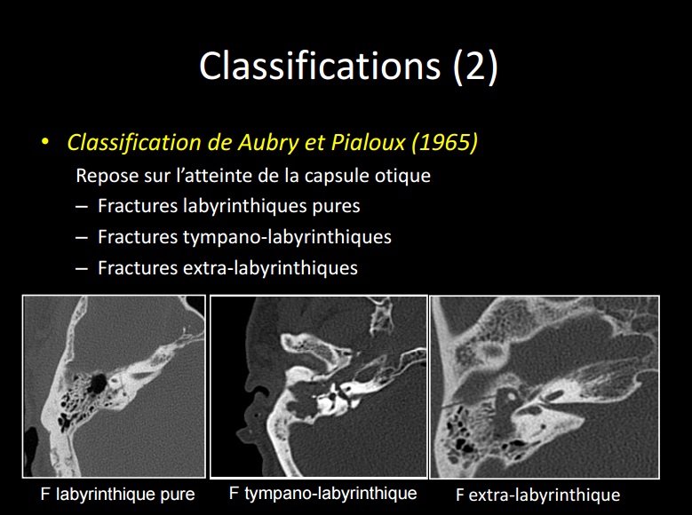 Ma bibliothèque en Imagerie Médicale: FRACTURE DU ROCHER