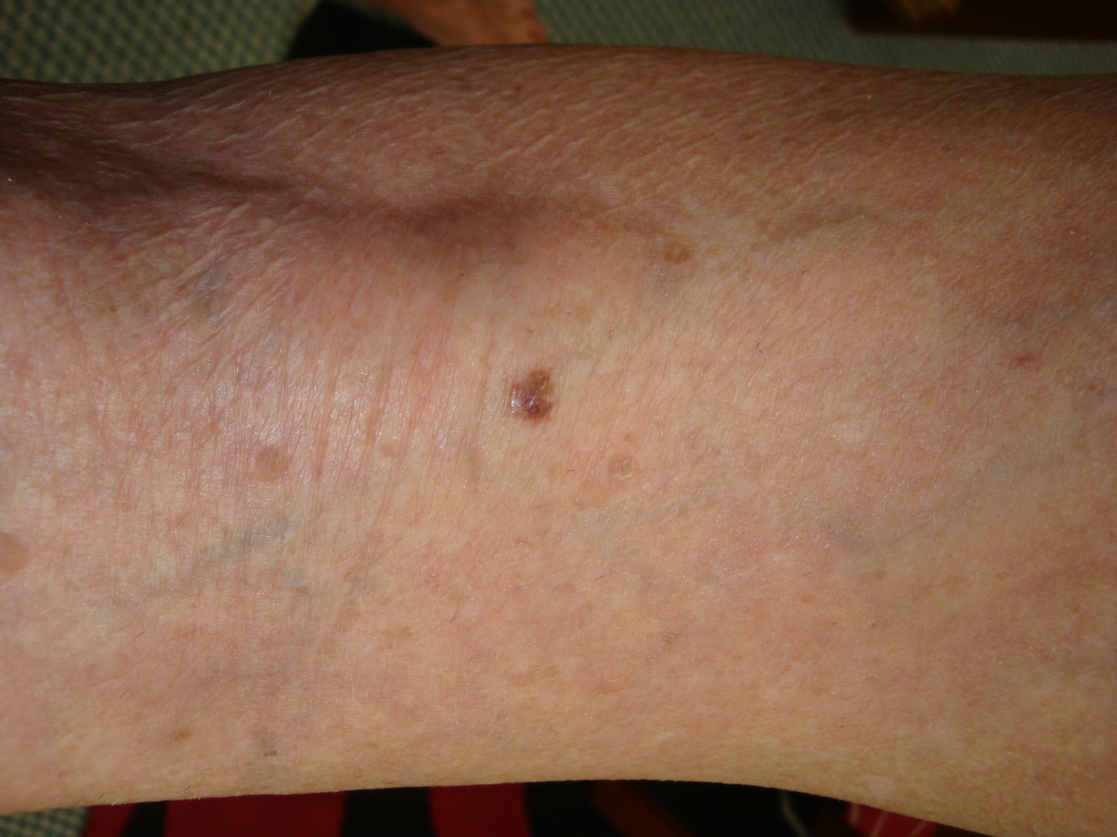 Consultations in Dermatoscopy: Three cases