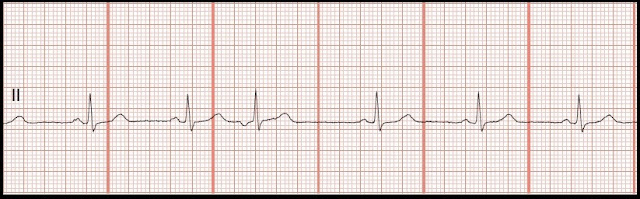 Practice EKG Rhythm Strips 126