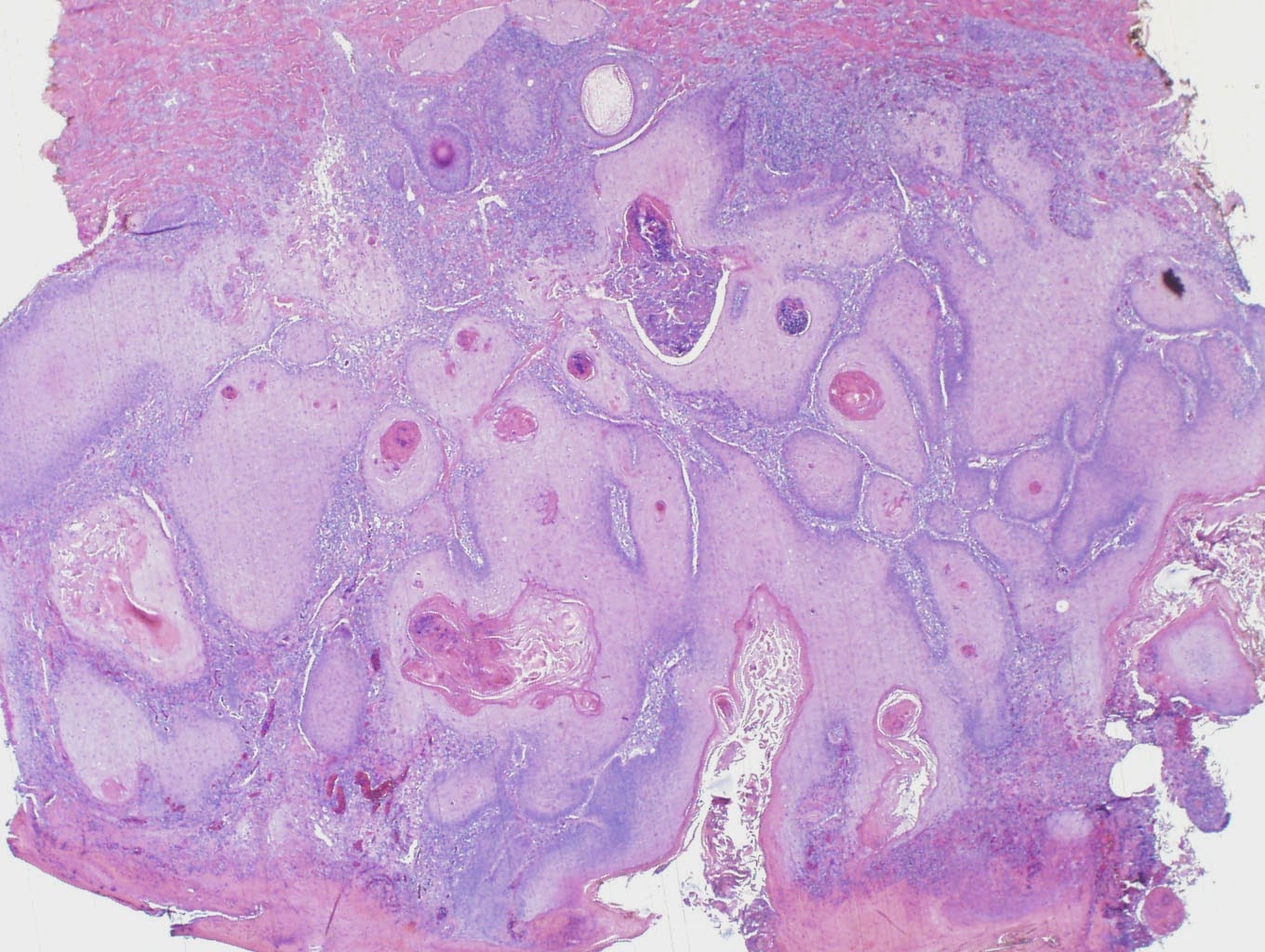 VIRTUAL GRAND ROUNDS IN DERMATOLOGY 2.0: Prurigo Nodularis with ...