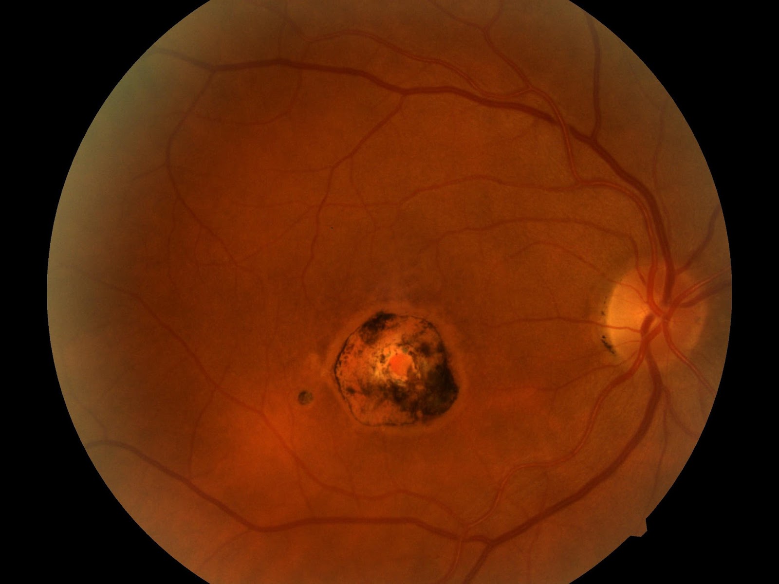 Ocular Histoplasmosis Macular Scars Ocular