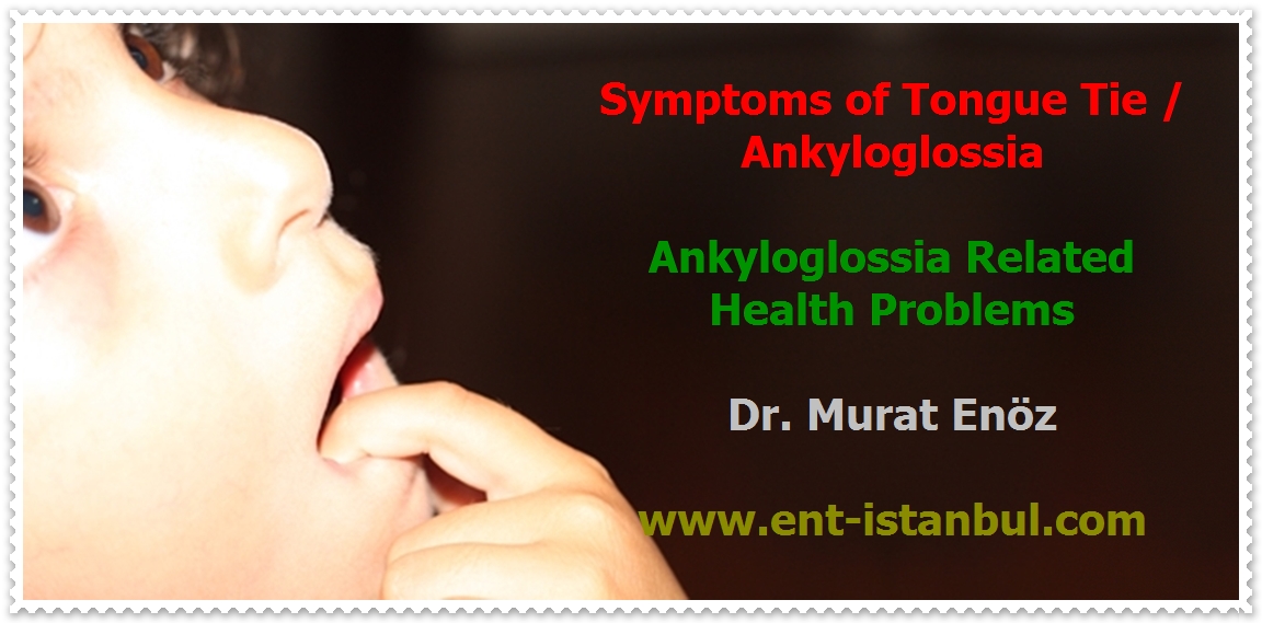 Tongue Tie (Ankyloglossia) - Definition, Symptoms, Diagnosis and Treatment