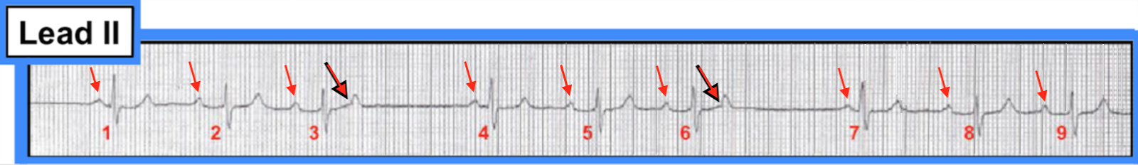 ECG Interpretation: ECG Blog #147 (AV Block - PACs - Mobitz I, II).